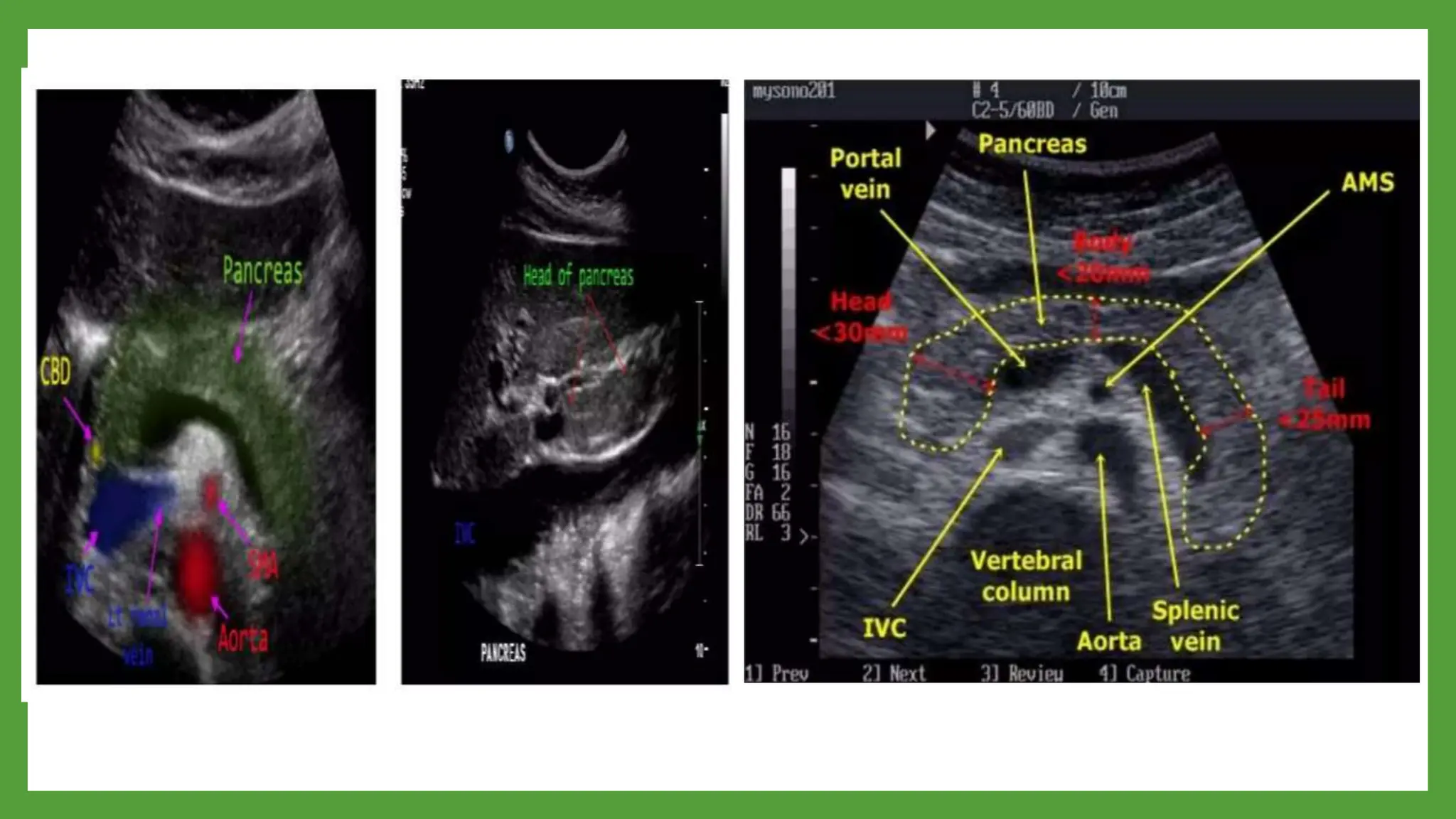 PANCREATIC ANOMALY radiology.pptx