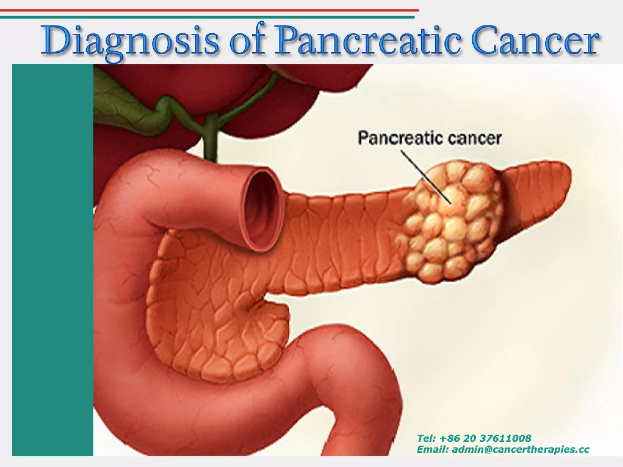 Diagnosis of Pancreatic Cancer | ODP