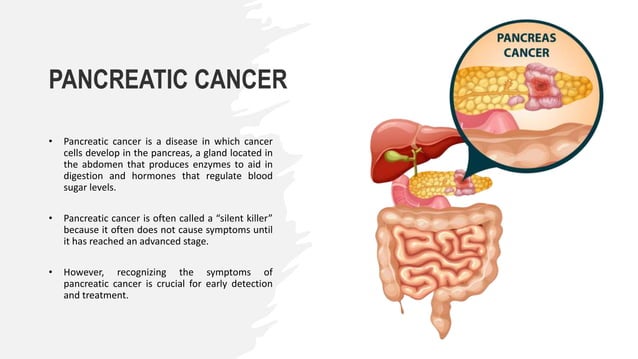 Pancreatic Cancer : Symptoms, Cause, and Treatments Options | PPT