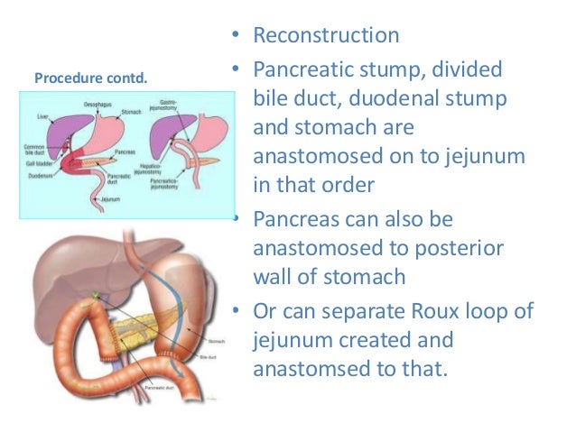 Pancreatic carcinoma