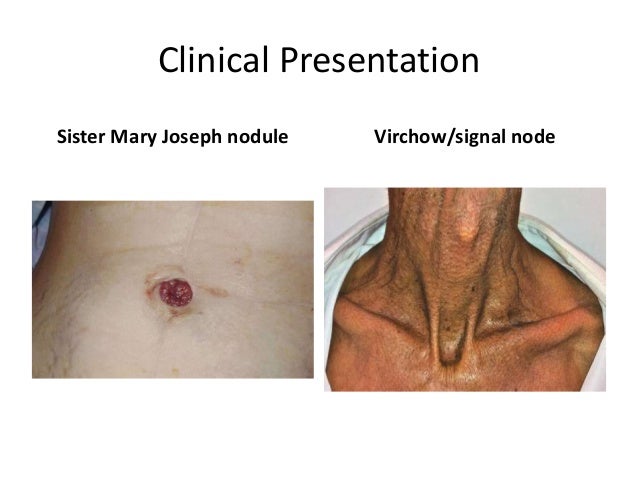 Pancreatic Carcinoma