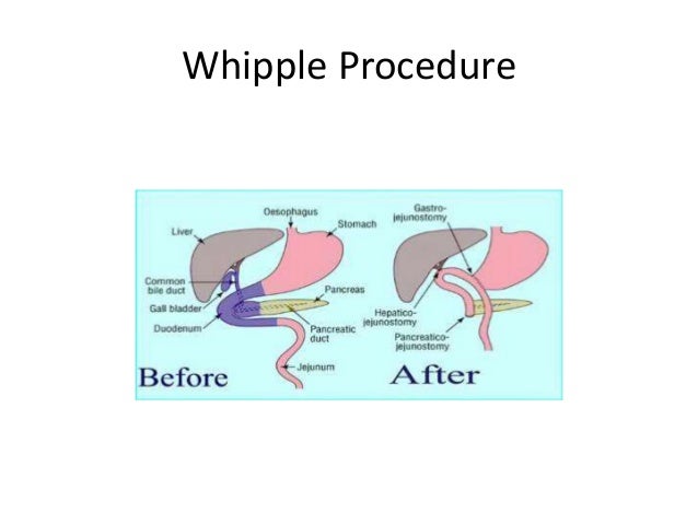Pancreatic Carcinoma