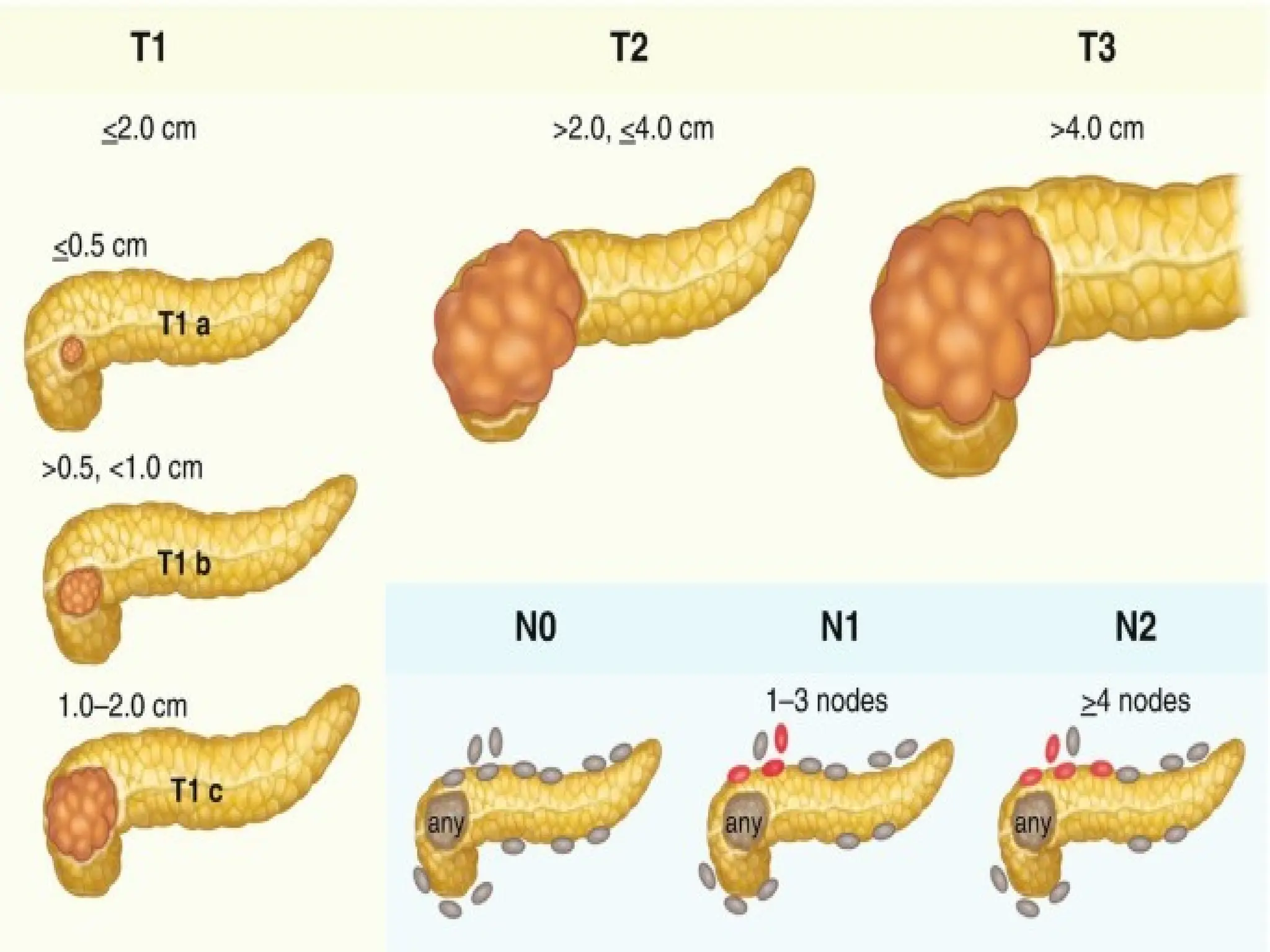 Pancreatic Carcinoma and its detailed discussion | PPTX