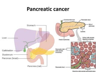 Pancreatic carcinoma dr mnr | PPT