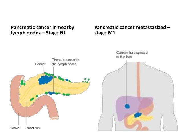 Pancreatic carcinoma dr mnr
