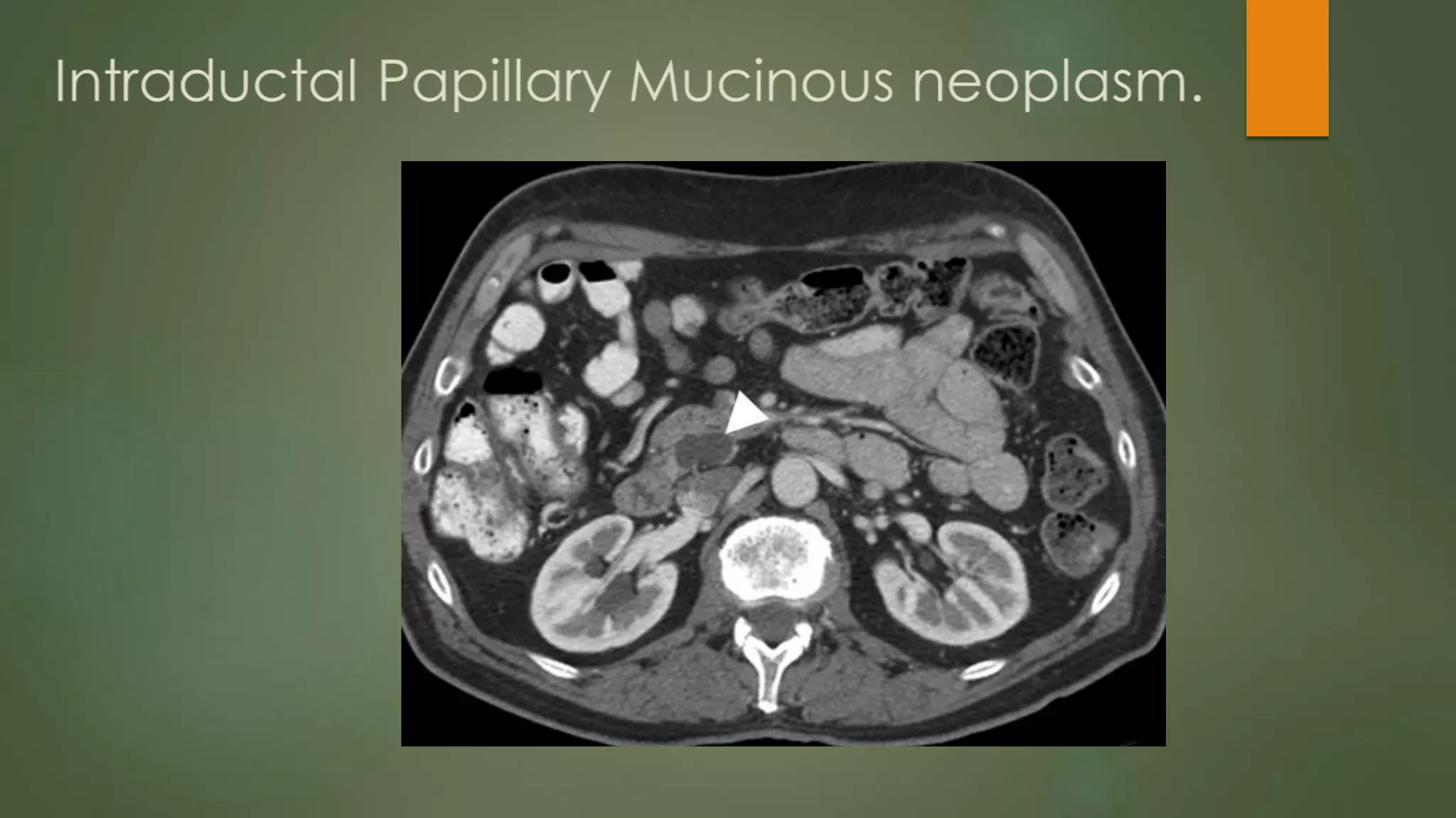 Pancreatic cystic neoplasm: Definition, Classification, Diagnosis and ...
