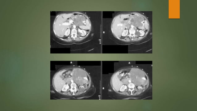 Pancreatic cystic neoplasm: Definition, Classification, Diagnosis and ...