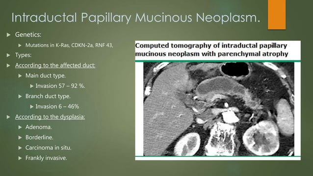 Pancreatic cystic neoplasm: Definition, Classification, Diagnosis and ...