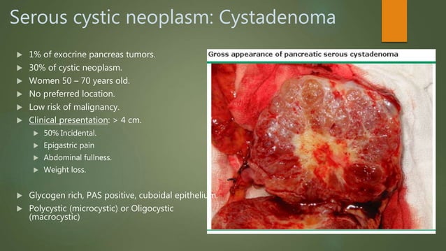 Pancreatic cystic neoplasm: Definition, Classification, Diagnosis and ...