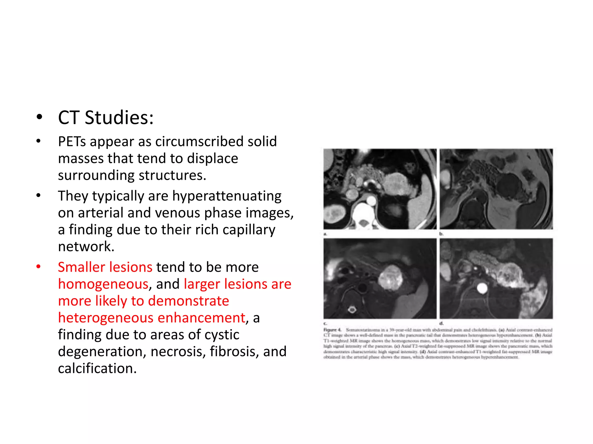 Pancreatic Endocrine Tumor imaging2.pptx