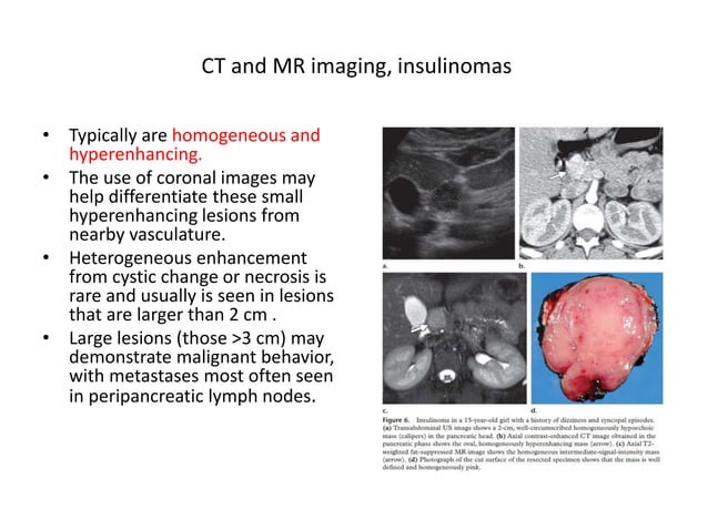 Pancreatic Endocrine Tumor imaging2.pptx
