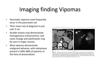 Pancreatic Endocrine Tumor imaging2.pptx