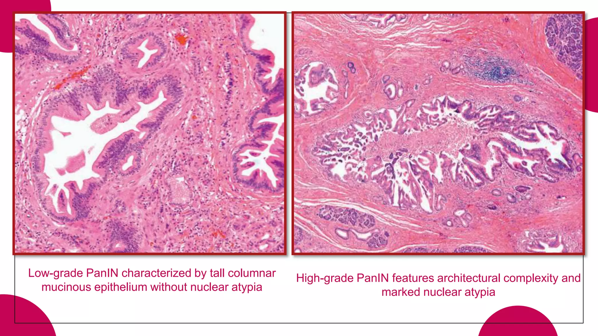 PANCREATIC NEOPLASM HISTOPATHOLOGY .pptx