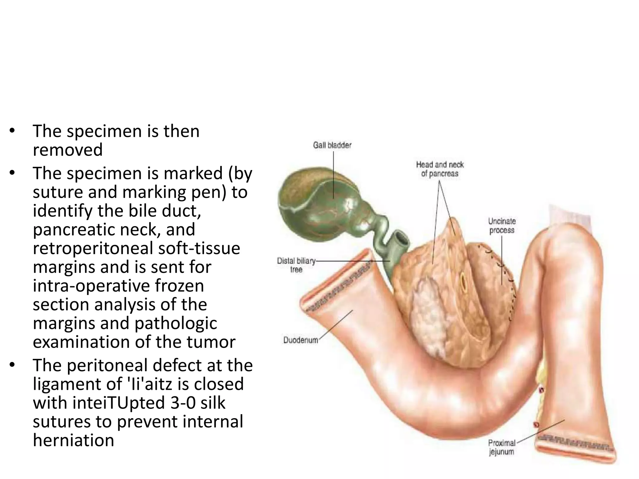 Pancreaticoduodenectomy (whipple procedure) | PPTX