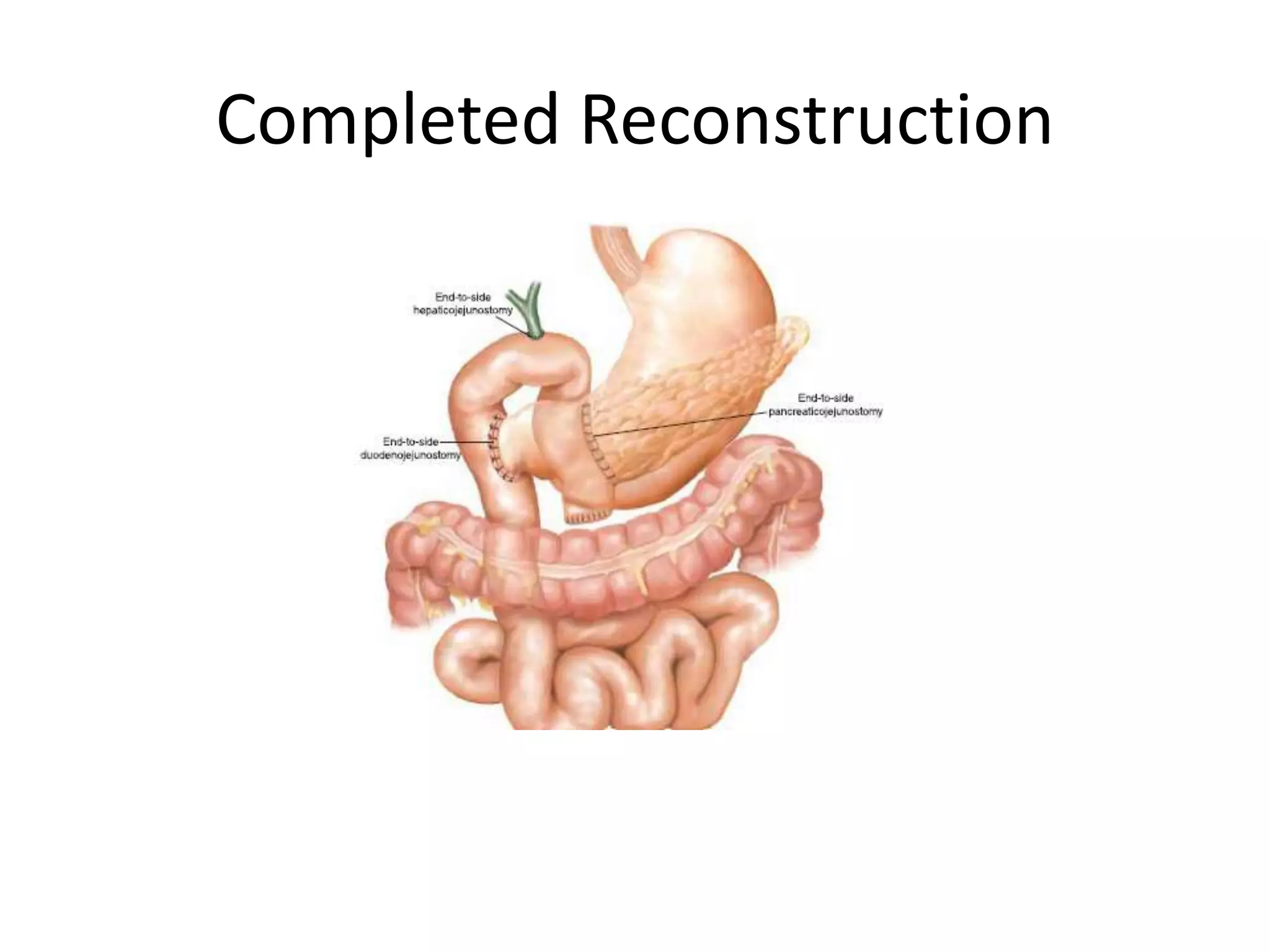 Pancreaticoduodenectomy (whipple procedure) | PPTX