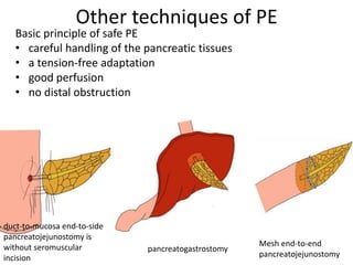 Pancreaticoduodenectomy (whipple procedure) | PPTX