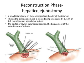 Pancreaticoduodenectomy (whipple procedure) | PPTX