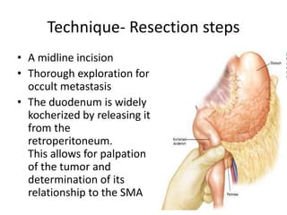 Whipple Procedure Steps