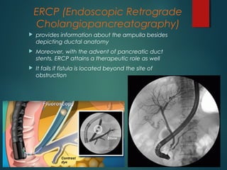 Pancreatico pleural fistula | PPT