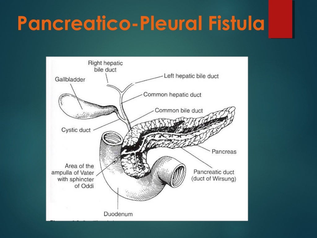 Pancreatico pleural fistula