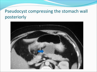 Pancreatic pseudocyst | PPT