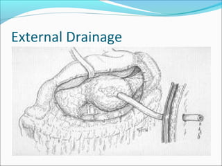 Pancreatic Pseudocyst Drainage