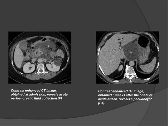 Pancreatic pseudocyst.pptx