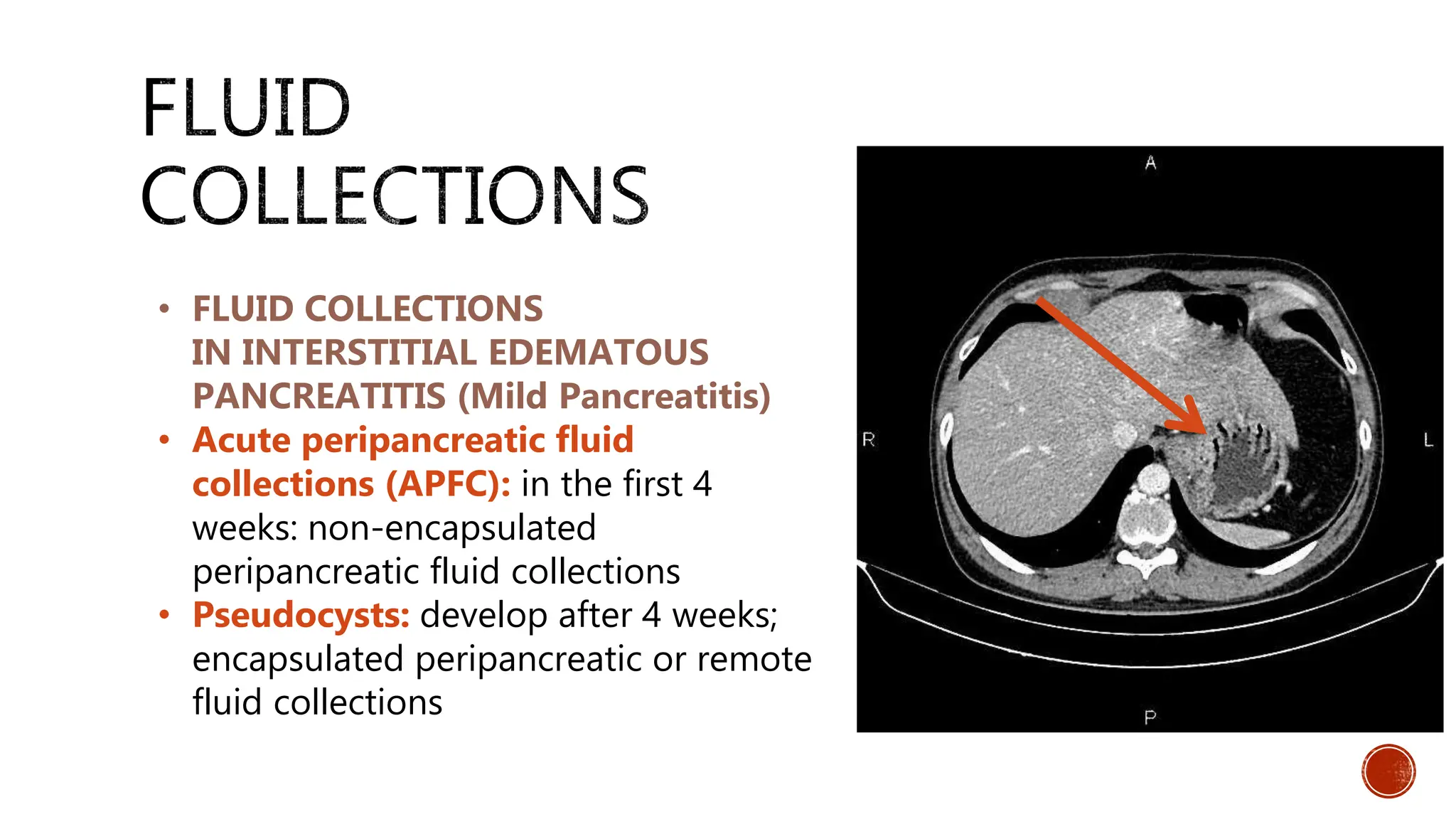 Pancreatic Pseudocyst - Dr Imran Ali Arain.pptx