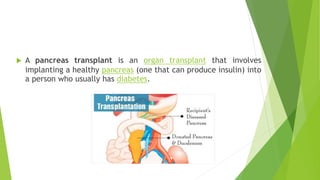 Pancreatic transplant.dr quiyum | PPTX