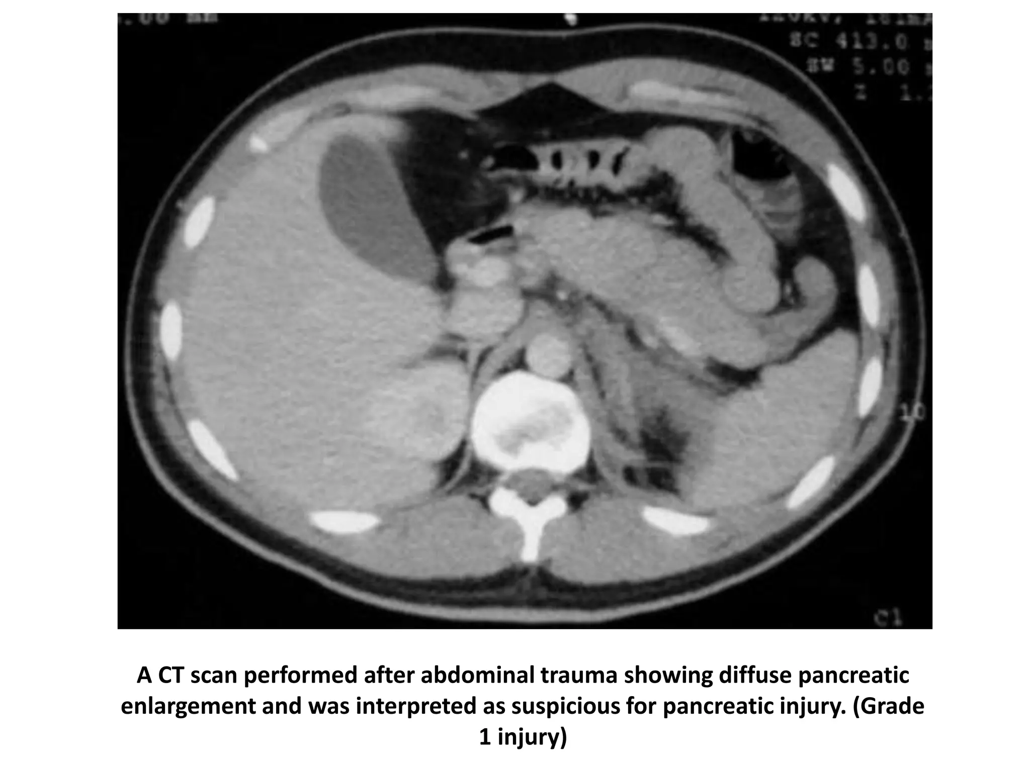 Pancreatic Trauma | PPTX