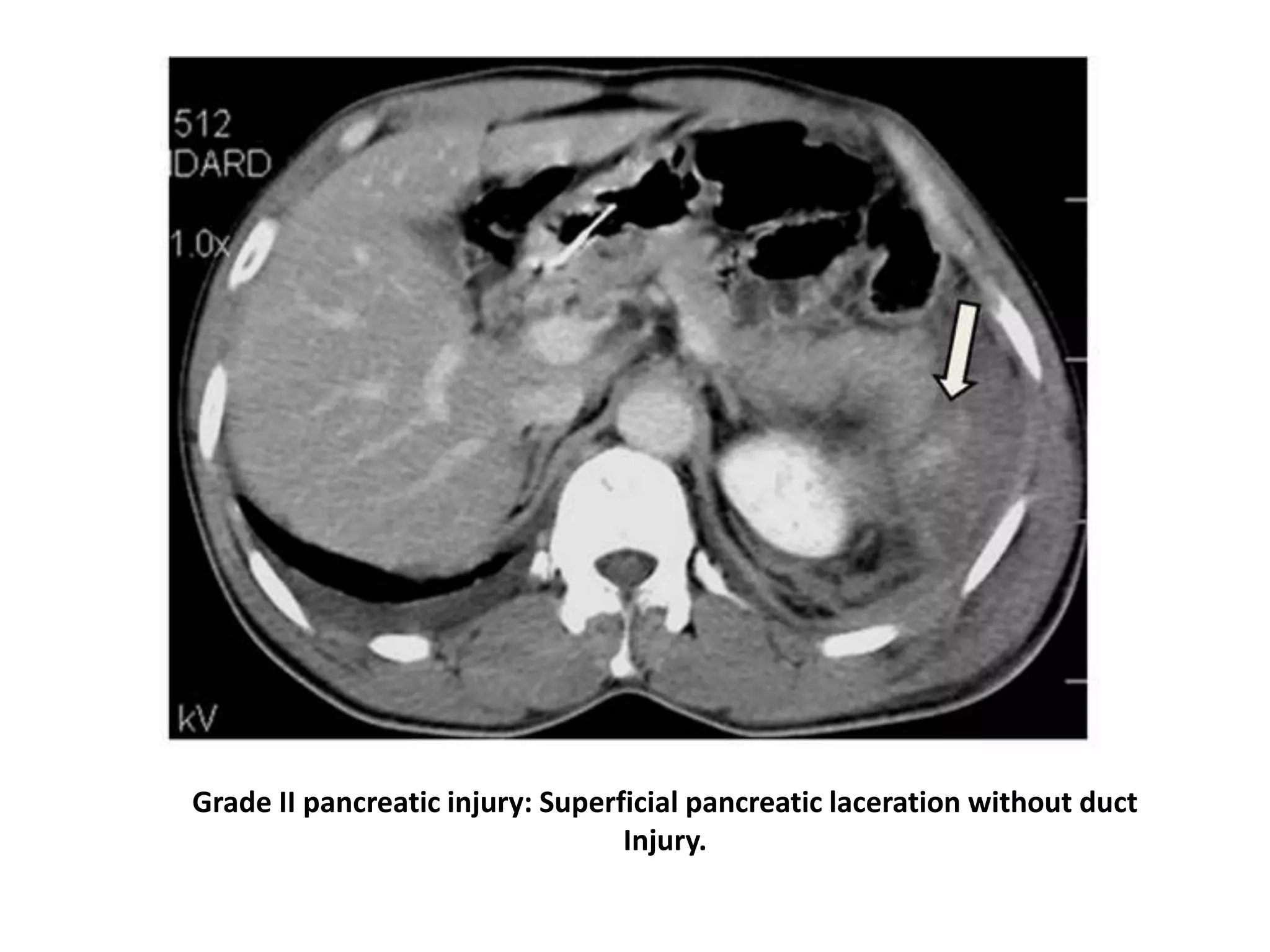 Pancreatic Trauma | PPTX