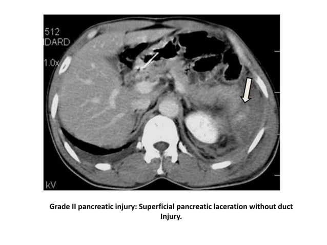 Pancreatic Trauma | PPTX