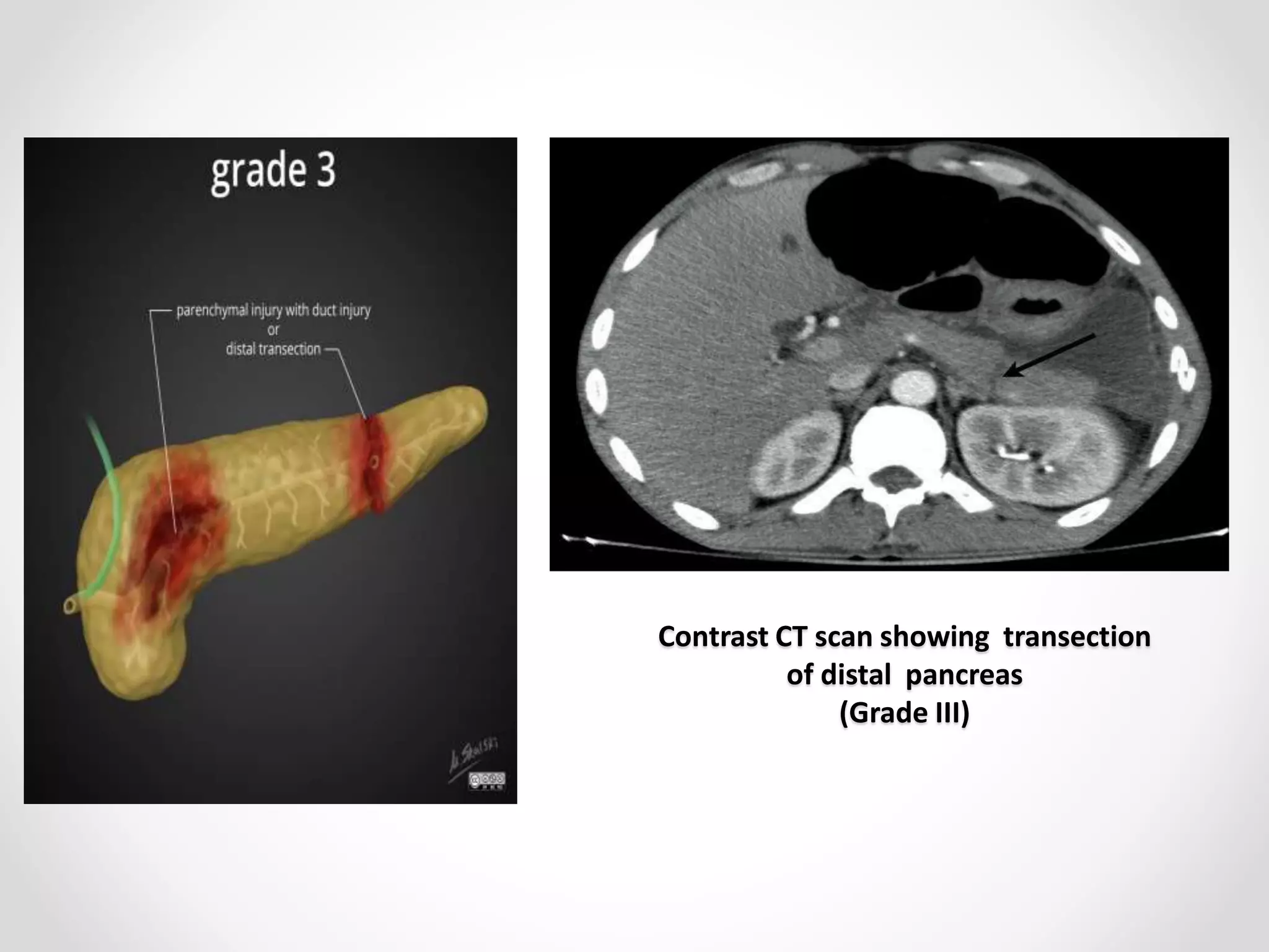Pancreatic trauma | PPTX