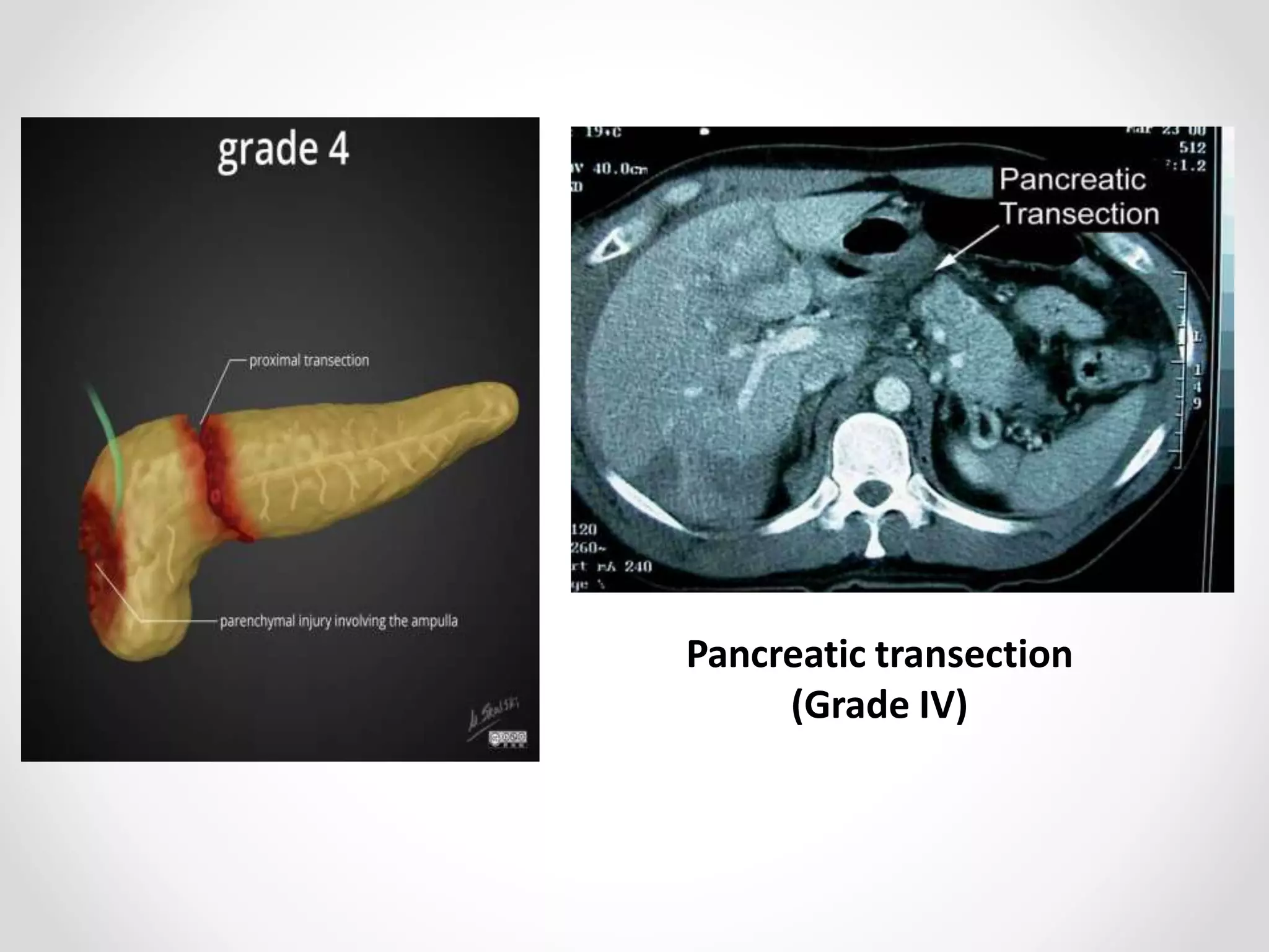 Pancreatic trauma | PPTX