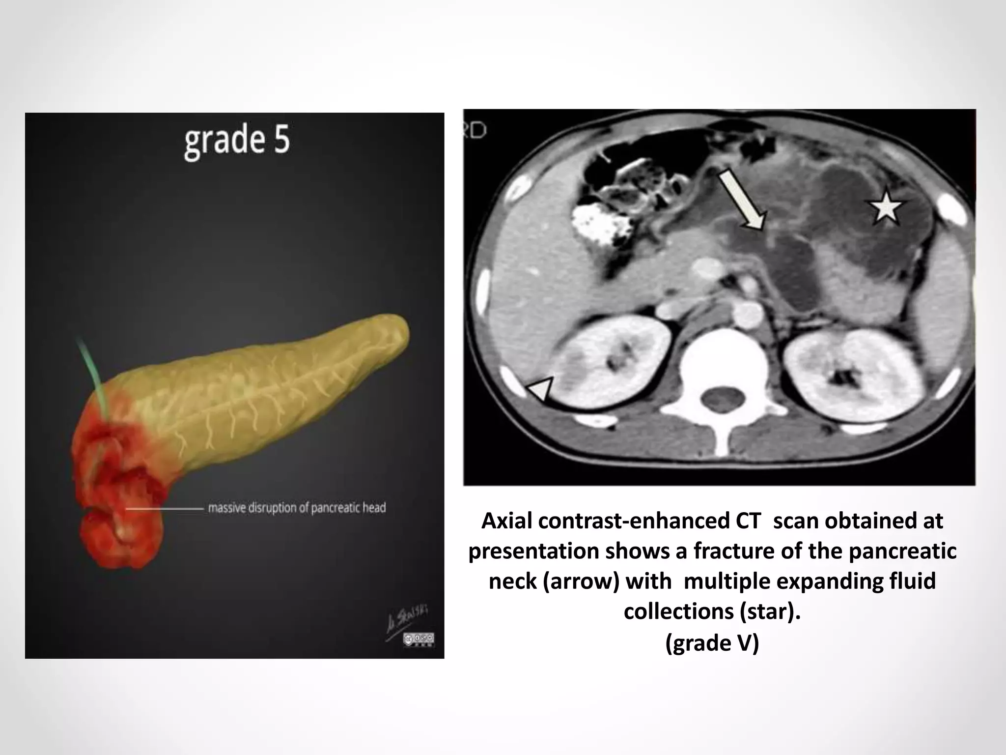 Pancreatic trauma | PPTX
