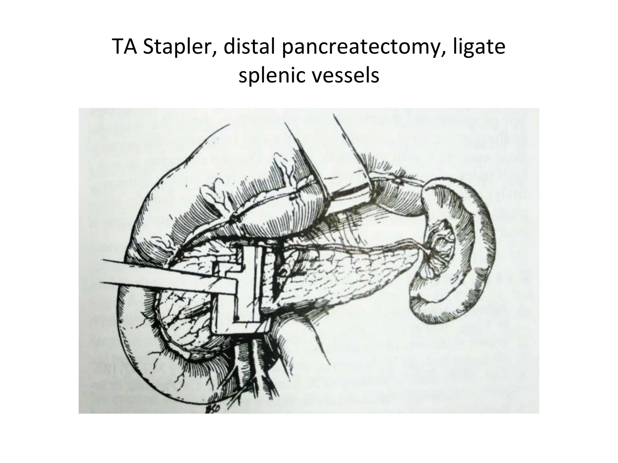 pancreatic trauma and its management.pptx