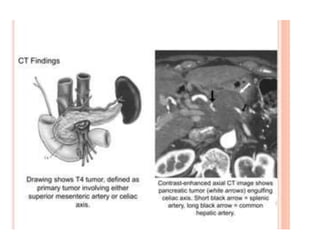 PANCREATIC TUMORS.pptx