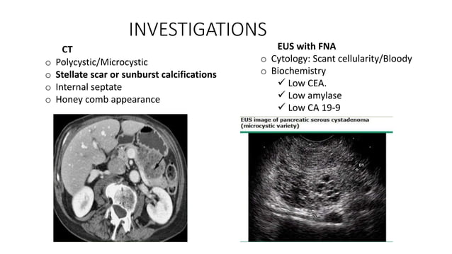 Pancreatic tumors .pptx