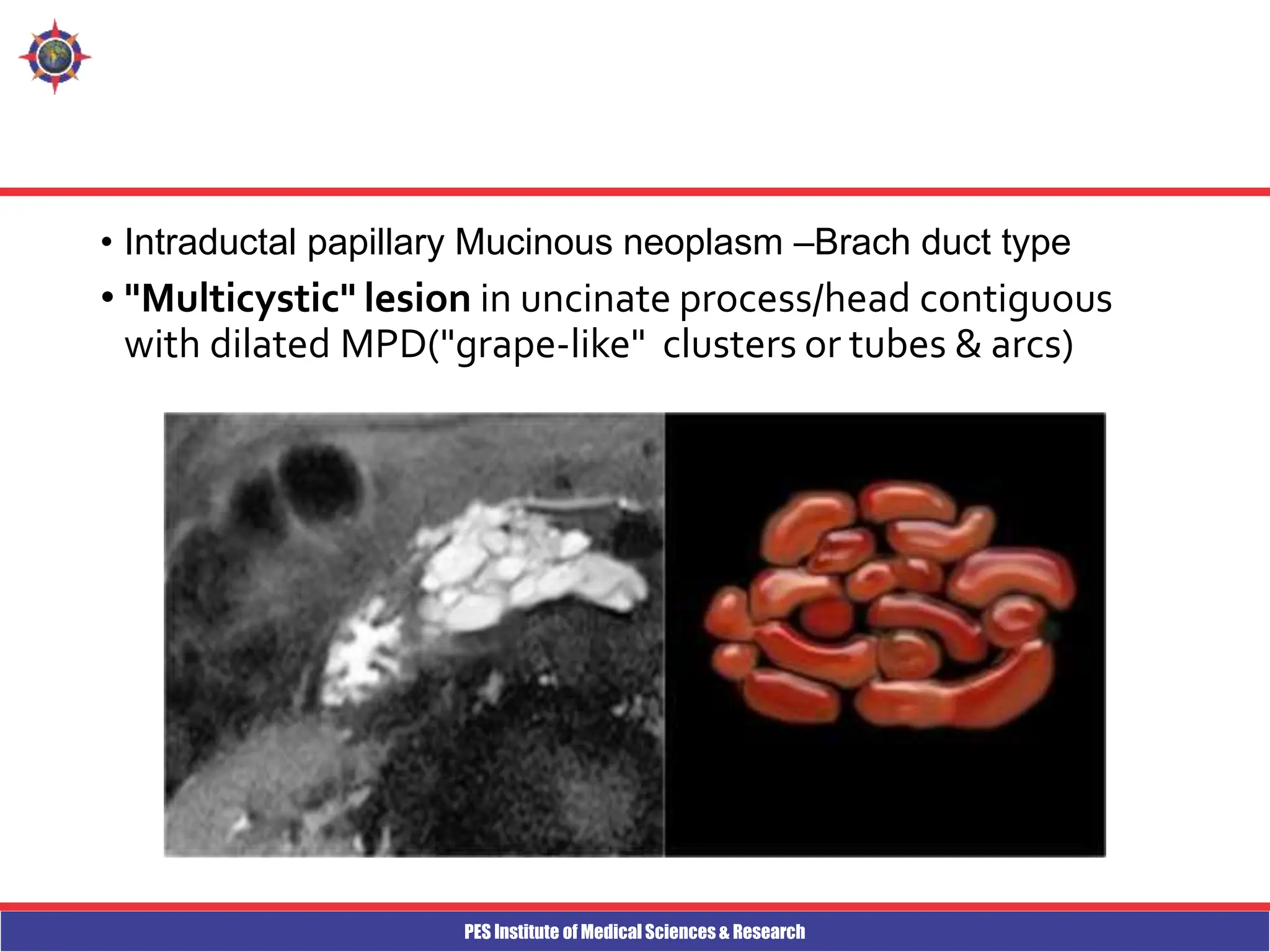 PANCREATIC TUMOURS radiology imaging.pptx
