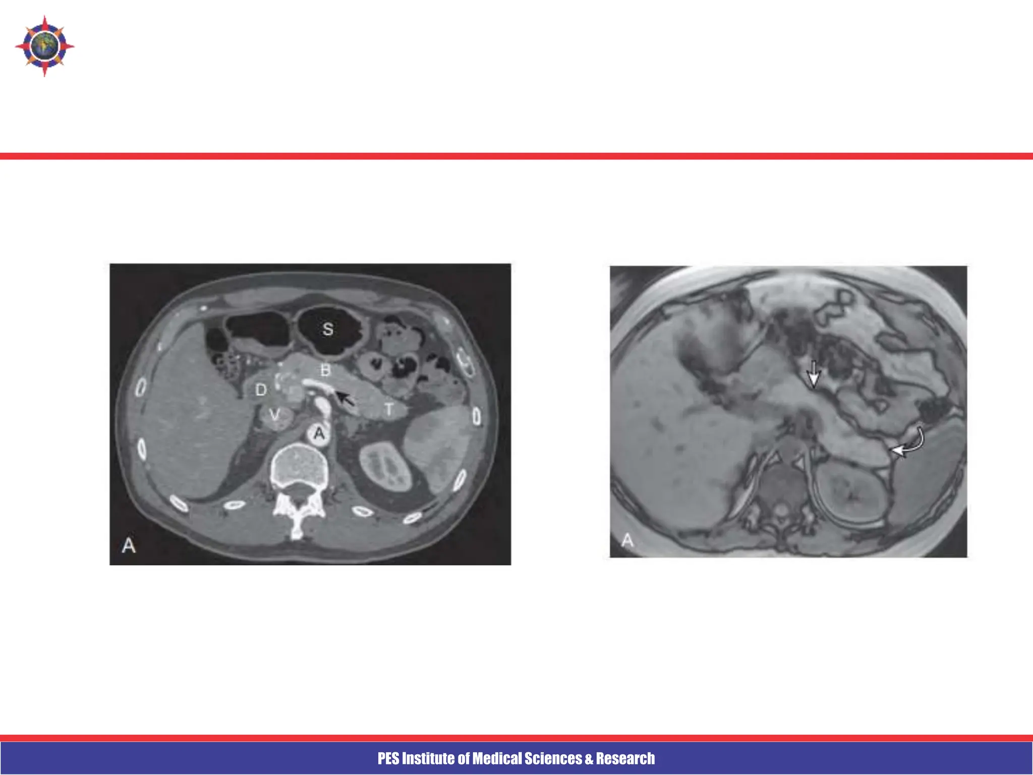 PANCREATIC TUMOURS radiology imaging.pptx
