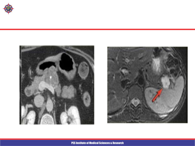 PANCREATIC TUMOURS radiology imaging.pptx