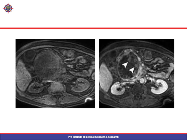 PANCREATIC TUMOURS radiology imaging.pptx
