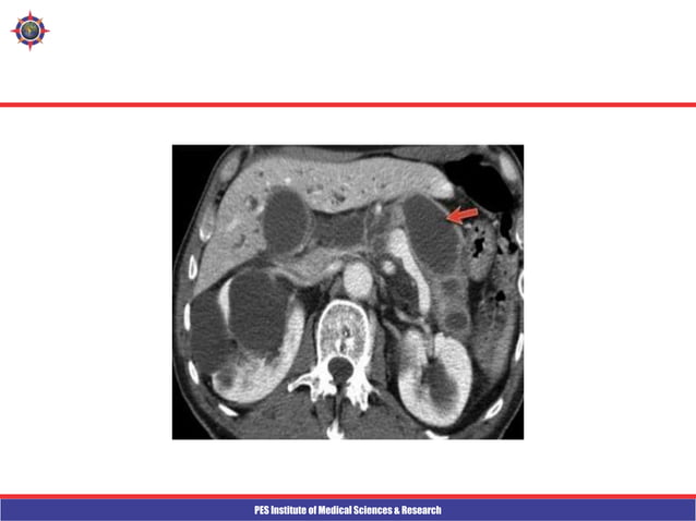 PANCREATIC TUMOURS radiology imaging.pptx