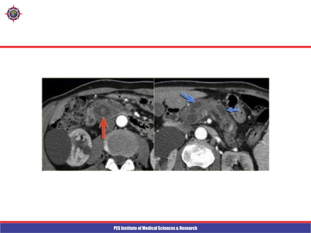 PANCREATIC TUMOURS radiology imaging.pptx