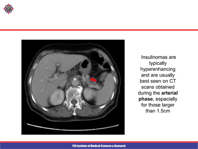 PANCREATIC TUMOURS radiology imaging.pptx