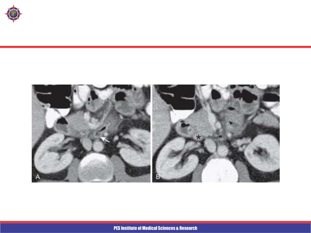 PANCREATIC TUMOURS radiology imaging.pptx