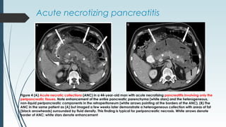 Pancreatitis | PPT