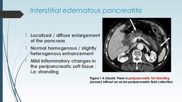 Pancreatitis