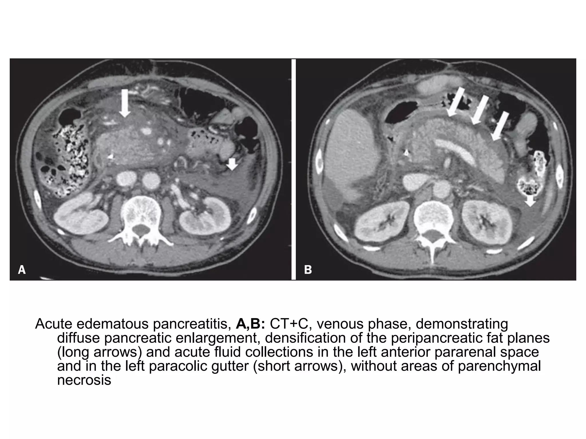 Diagnostic Imaging of Pancreatitis | PPT