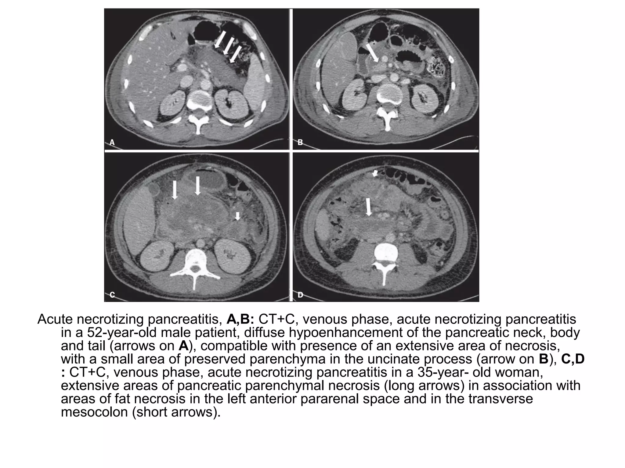 Diagnostic Imaging of Pancreatitis | PPT